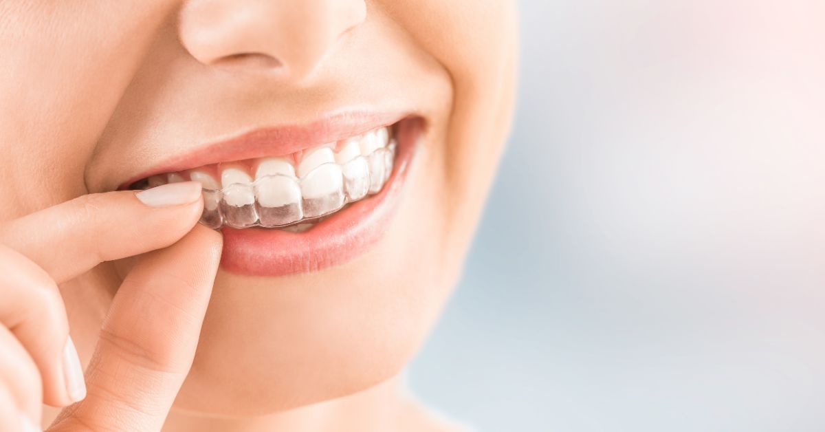 Invisible Orthodontics: Get Straight Teeth Without Metal Braces | Pearl ...