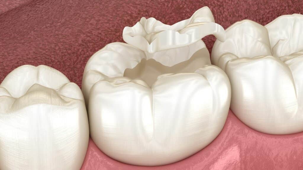 Dental Inlays And Onlays | Pearl Street Dental Boulder